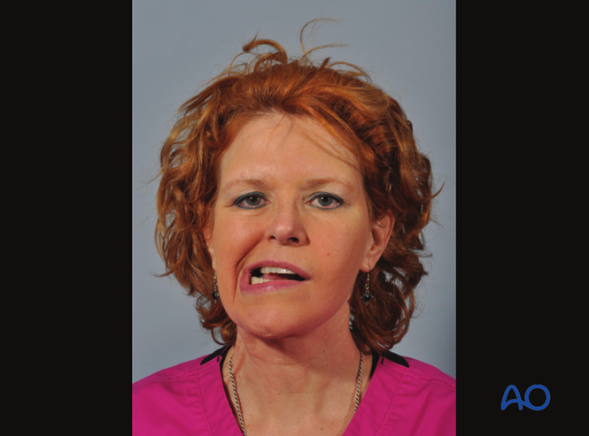 Physical therapy for Mandibular hypomobility/ankylosis