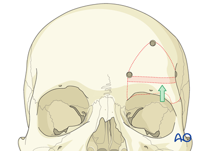 Orbitotomy with orbital roof repositioning for Supraorbital ridge ...