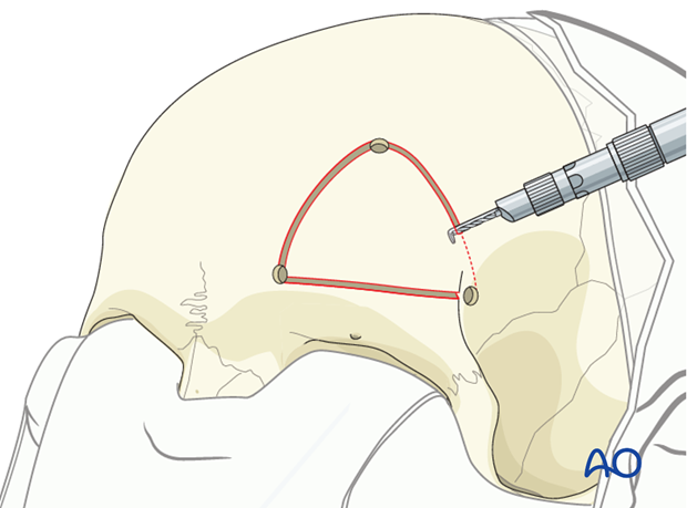 Orbitotomy with orbital roof repositioning for Supraorbital ridge ...