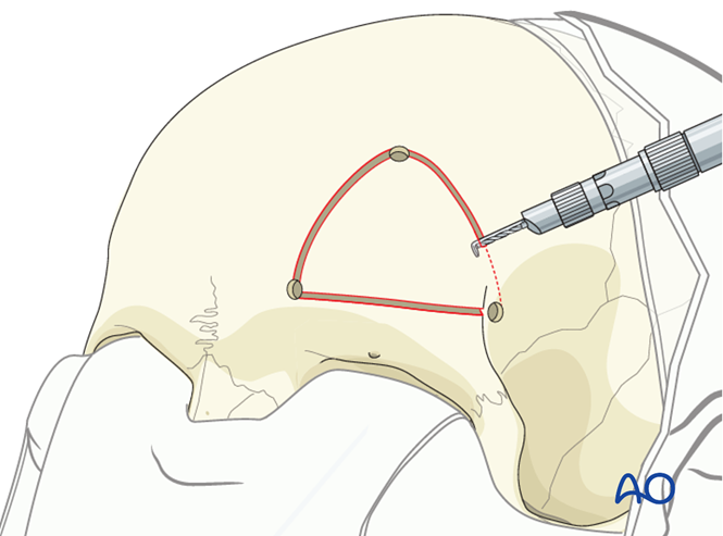 Orbitotomy with orbital roof repositioning for Supraorbital ridge ...