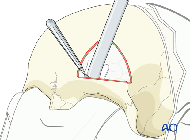 Orbitotomy with orbital roof repositioning for Supraorbital ridge ...