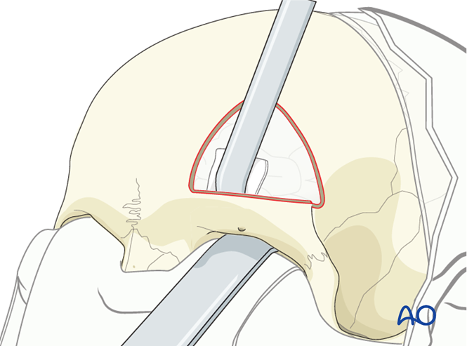 Orbitotomy with orbital roof repositioning for Supraorbital ridge ...