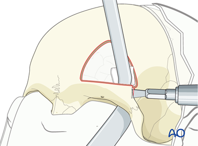 Orbitotomy with orbital roof repositioning for Supraorbital ridge ...