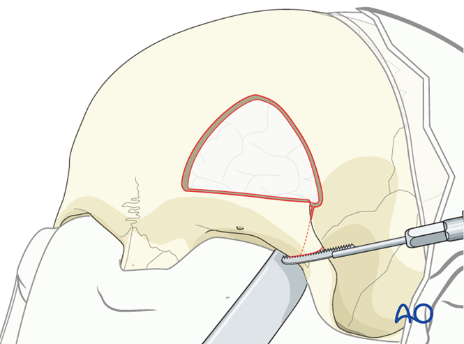Orbitotomy with orbital roof repositioning for Supraorbital ridge ...