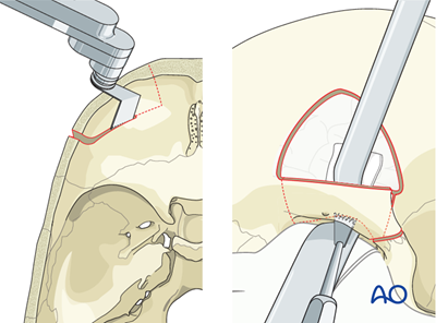 Orbitotomy with orbital roof repositioning for Supraorbital ridge ...