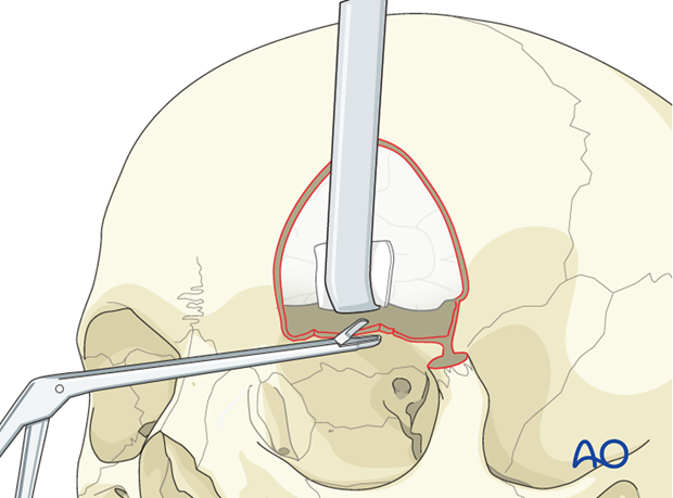 Orbitotomy with orbital roof repositioning for Supraorbital ridge ...