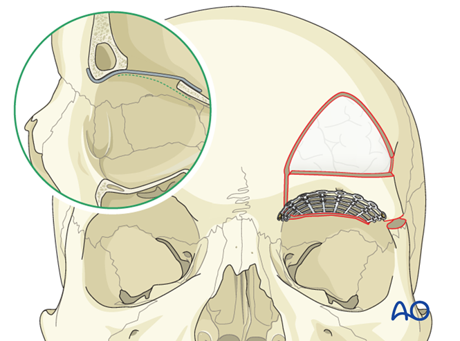 Orbitotomy with orbital roof repositioning for Supraorbital ridge ...
