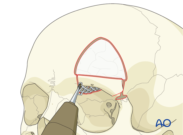 Orbitotomy with orbital roof repositioning for Supraorbital ridge ...