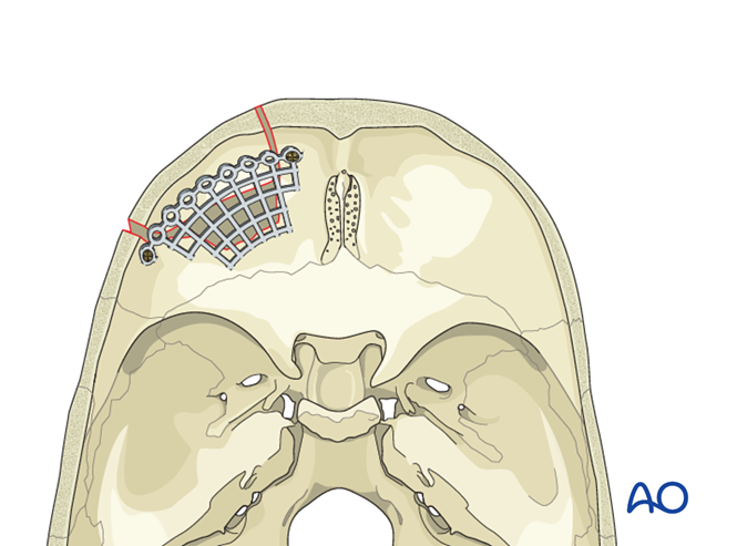 Orbitotomy with orbital roof repositioning for Supraorbital ridge ...