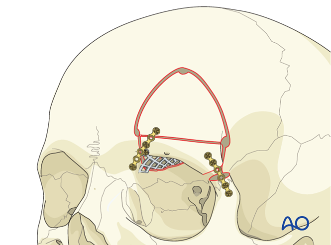 Orbitotomy with orbital roof repositioning for Supraorbital ridge ...