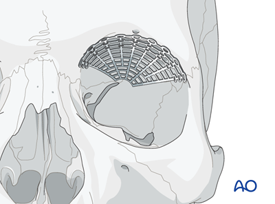 Orbitotomy with orbital roof repositioning for Supraorbital ridge ...