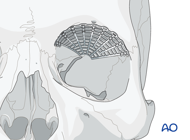 Orbitotomy with orbital roof repositioning for Supraorbital ridge ...
