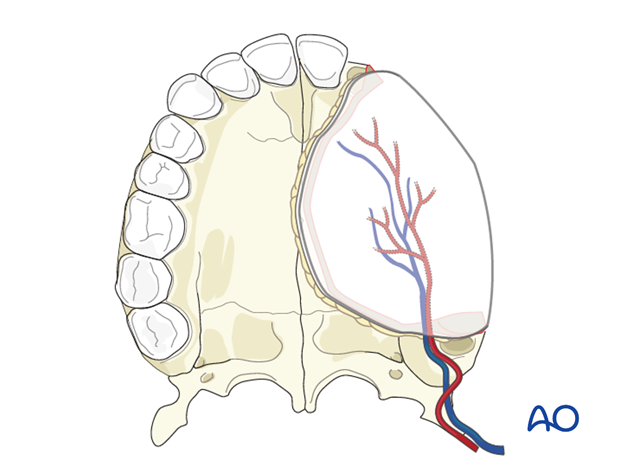 Radial forearm free flap for Alveolar defects in the maxilla