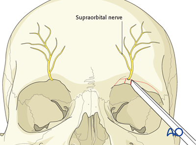 Contouring for Supraorbital ridge/orbital roof malposition