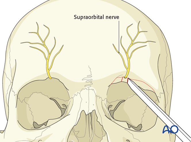 Contouring for Supraorbital ridge/orbital roof malposition