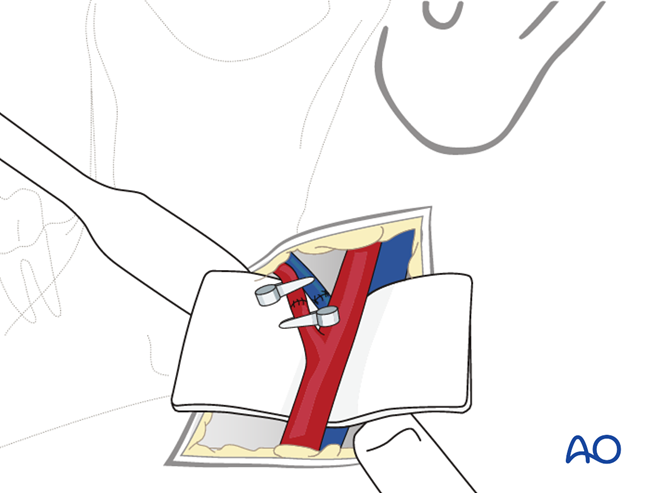Fibula osteocutaneous flap for Alveolar defects in the maxilla