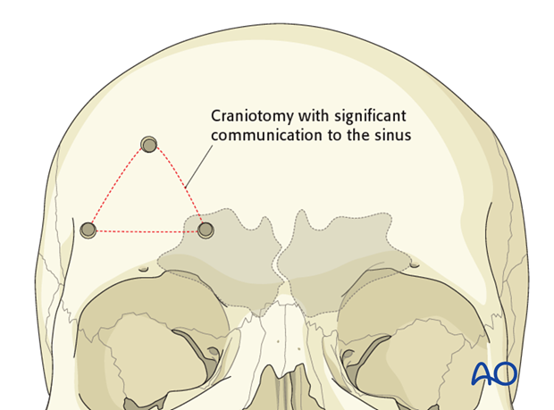 Sinus obliteration for Sinus outflow disease