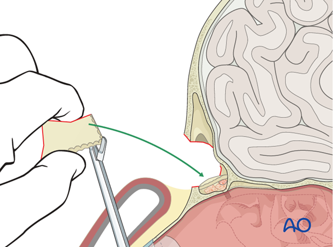 Sinus obliteration for Sinus outflow disease