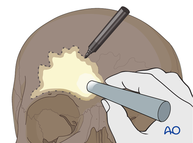 Cranialization for Sinus outflow disease