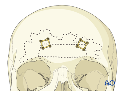 Cranialization for Sinus outflow disease