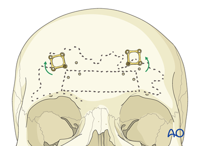 Cranialization for Sinus outflow disease