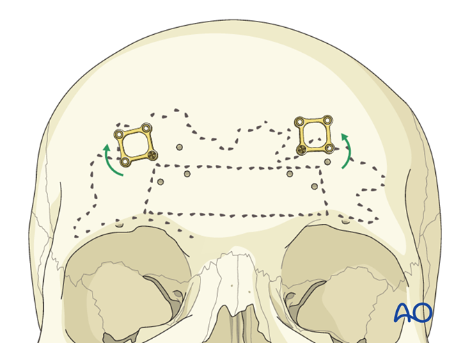 Cranialization for Sinus outflow disease