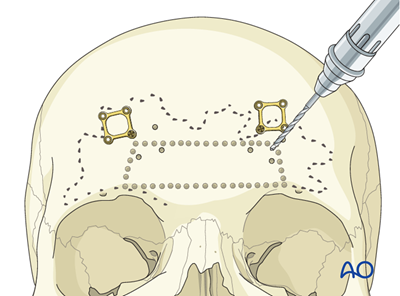 Cranialization for Sinus outflow disease
