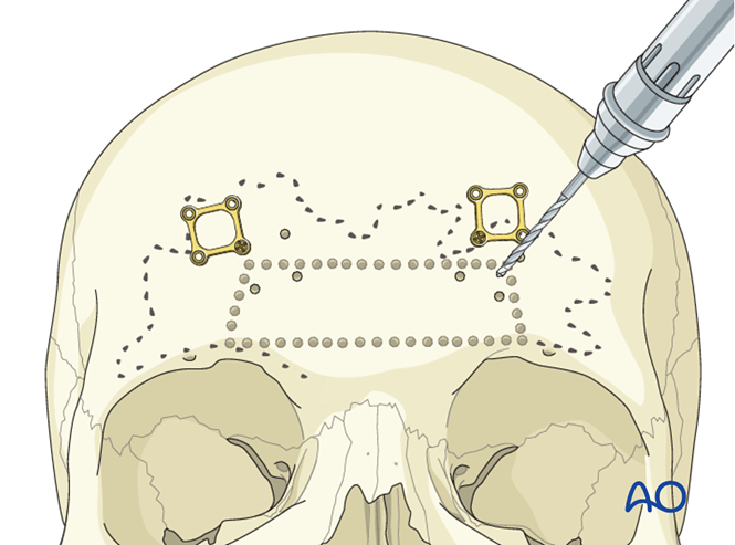 Cranialization for Sinus outflow disease