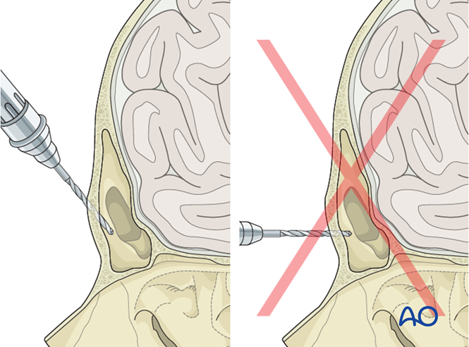Cranialization for Sinus outflow disease