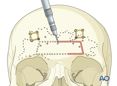Cranialization for Sinus outflow disease