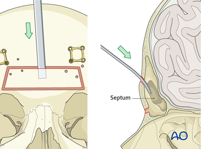 Cranialization for Sinus outflow disease
