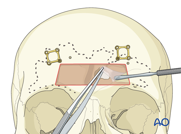 Cranialization for Sinus outflow disease