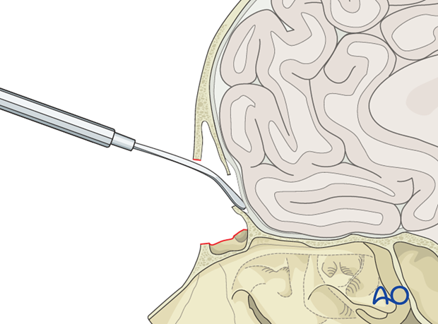 Cranialization for Sinus outflow disease