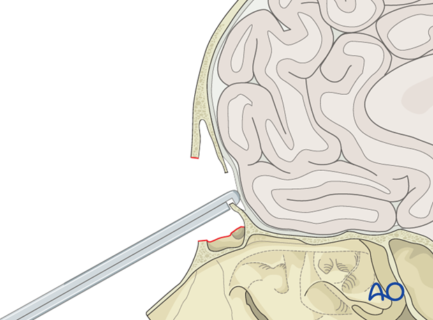 Cranialization for Sinus outflow disease