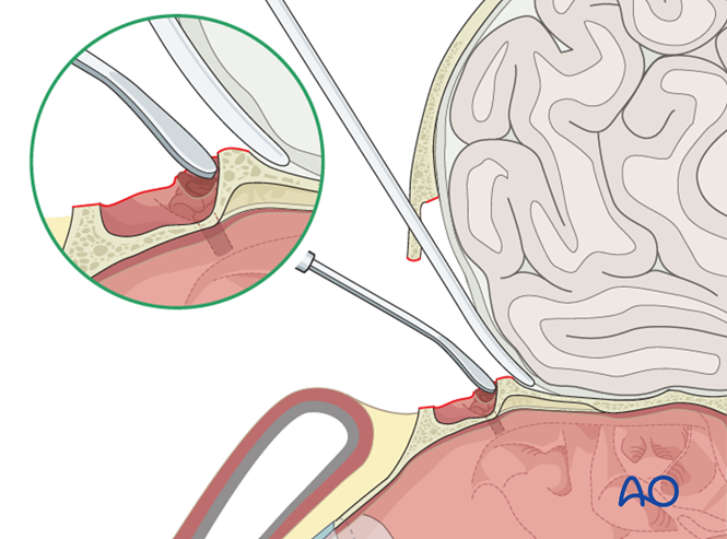Cranialization for Sinus outflow disease