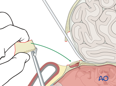 Cranialization for Sinus outflow disease