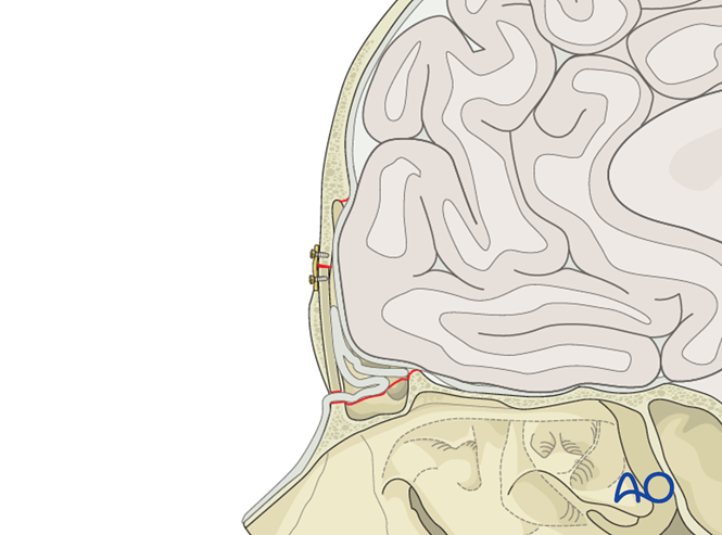 Cranialization for Sinus outflow disease