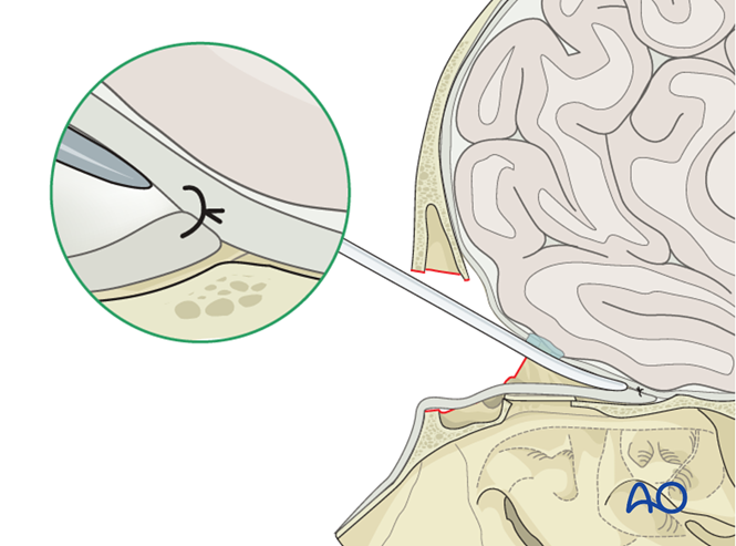 Subcranial CSF leak repair for CSF leak/encephalocele