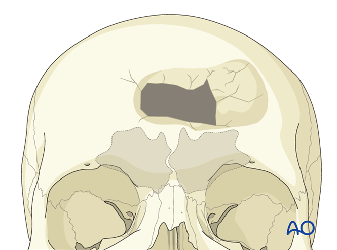 Cranioplasty for Frontal bone defects