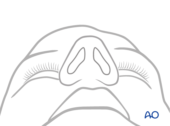 Examination of patients with midfacial post traumatic deformities