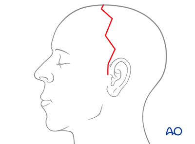 Orbitotomy with orbital roof repositioning for Supraorbital ridge ...