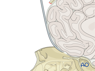Transcranial CSF leak repair for CSF leak/encephalocele