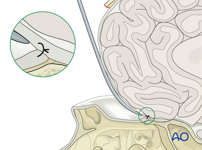 Transcranial CSF leak repair for CSF leak/encephalocele