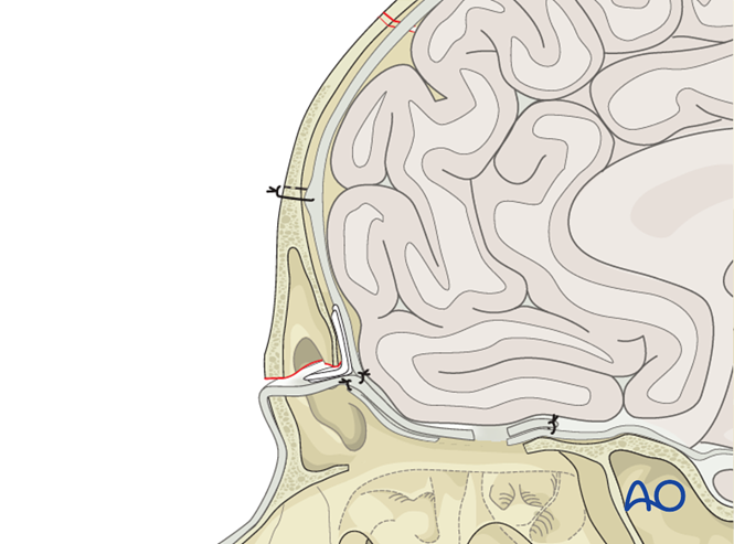 Transcranial CSF leak repair for CSF leak/encephalocele
