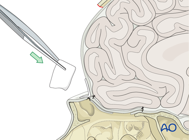 Transcranial CSF leak repair for CSF leak/encephalocele