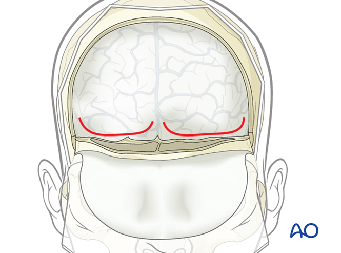 Transcranial CSF leak repair for CSF leak/encephalocele