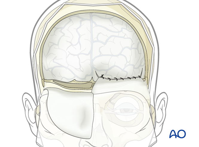 Transcranial CSF leak repair for CSF leak/encephalocele