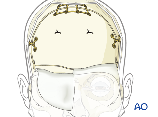 Transcranial CSF leak repair for CSF leak/encephalocele