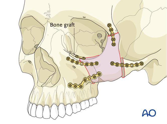 Orbitozygomatic osteotomy for Zygoma malposition
