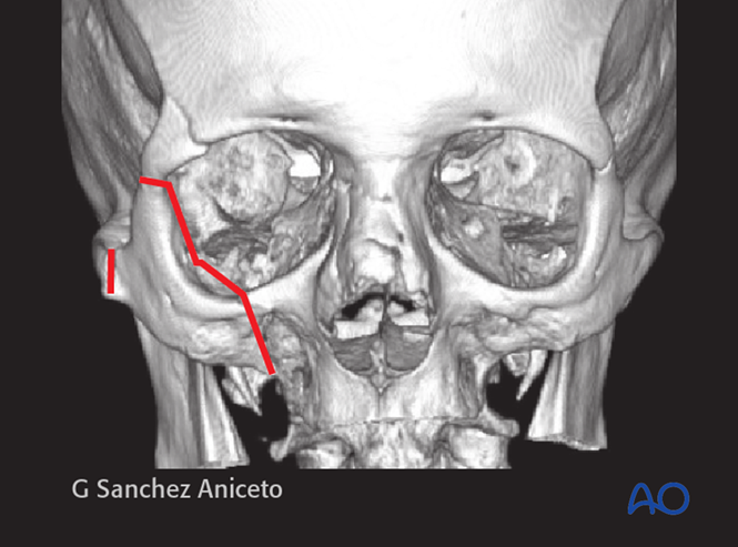 Orbitozygomatic osteotomy for Zygoma malposition